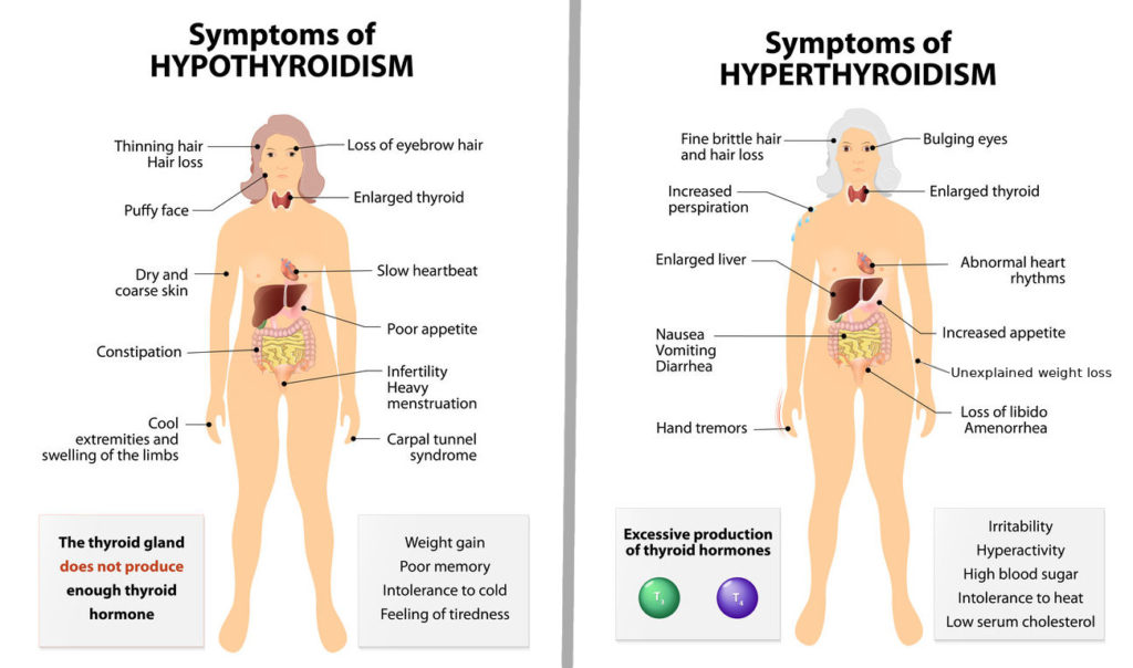 Hyperthyroidism Vs Hypothyroidism Hyperthyroidism And Hypothyroidism 